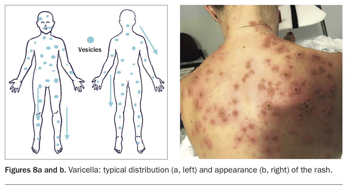 viral-exanthem-face